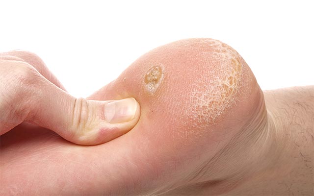 Fodvort - Fodklinikken Hals